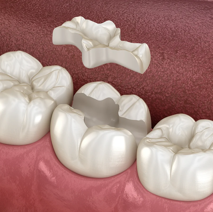 Inlay Restorations Salt Lake City | Conservative Repair